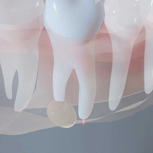 The Truth About Tooth Infections - Rose Dental Group