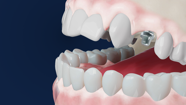 Dental Implants: A Long-term Solution for a Confident Smile - Rose ...